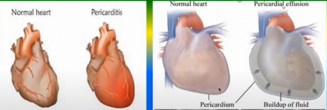 Scleroderma and Heart Conditions Management| PatientsEngage